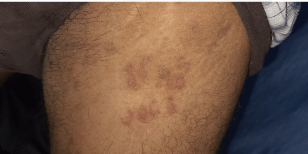 Is it a case of Diabetic Dermopathy? - CME INDIA