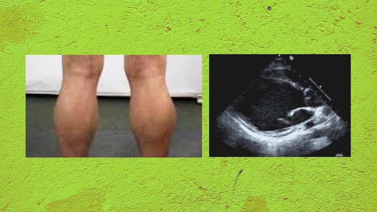 Spot The Diagnosis Of The Hypertrophy Of Calf Muscle CME INDIA