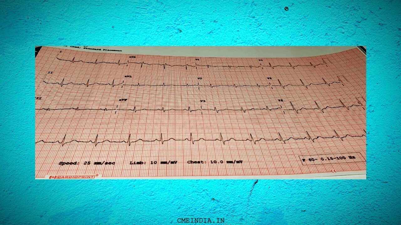 Recurrent Syncope with this ECG: How to Proceed? - CME INDIA