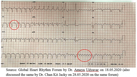 Use the ‘Bix Rule’ while interpreting SVT - CME INDIA