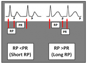 Use the ‘Bix Rule’ while interpreting SVT - CME INDIA
