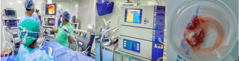 Endobronchial Mucormycosis Successfully Treated with Flexible ...