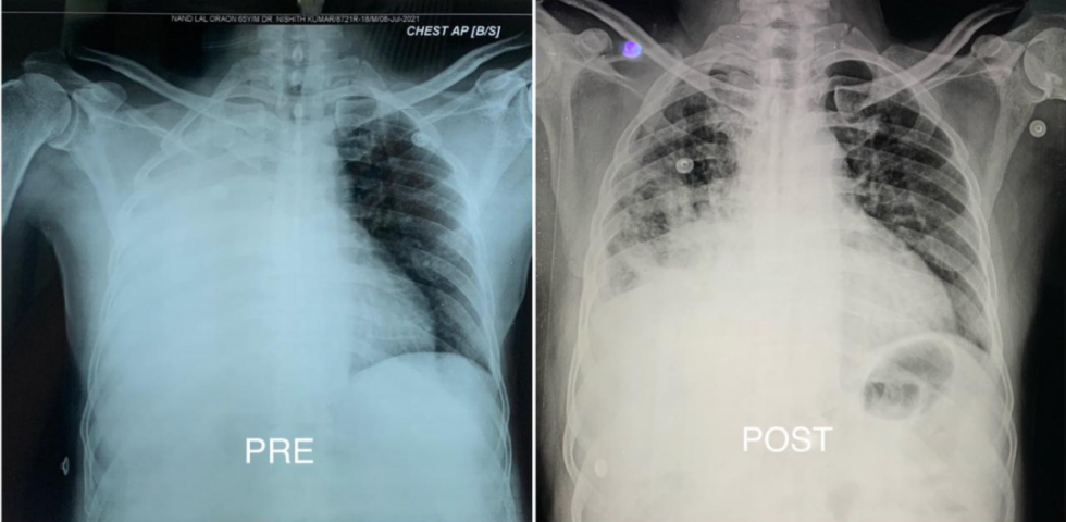 Endobronchial Mucormycosis Successfully Treated with Flexible ...