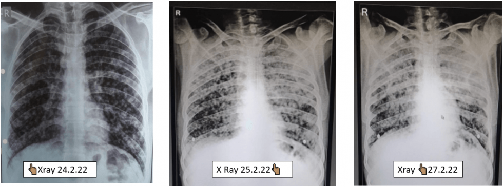 Was It Chicken Pox Pneumonia? - CME INDIA