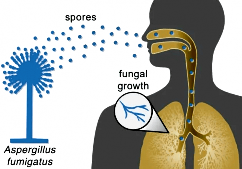 Pulmonary Aspergillosis - What You Must Know? - CME INDIA