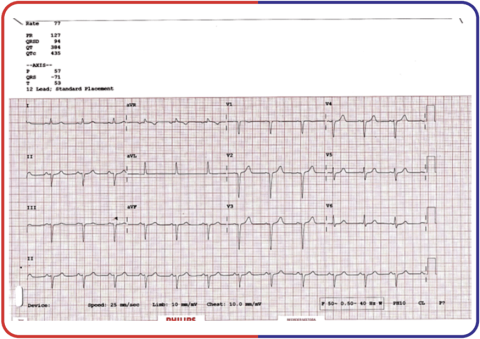 A Journey Through Interesting ECGs (Part-1) - CME INDIA